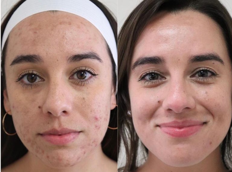 A Dermatologist's Accutane Guide - Timeline and Expectations